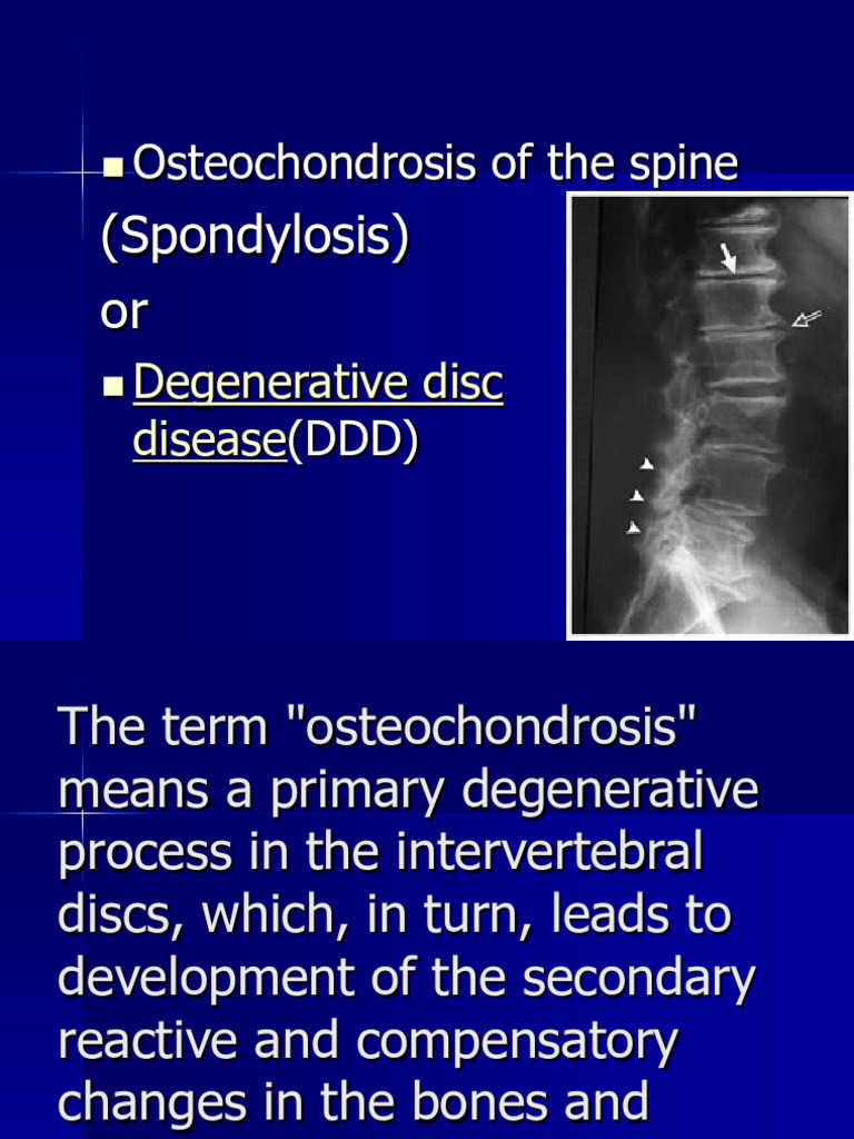 Osteochondrosis of The Spine | PDF | Vertebral Column | Back Pain