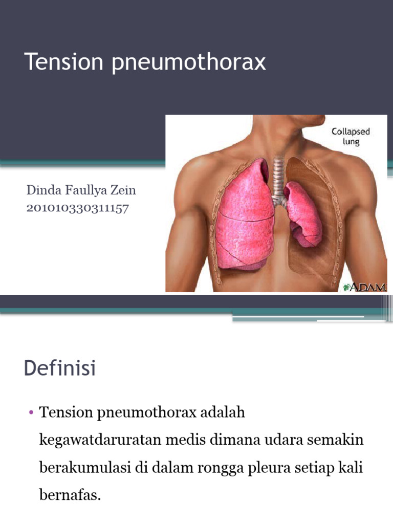 Tension Pneumothorax | PDF