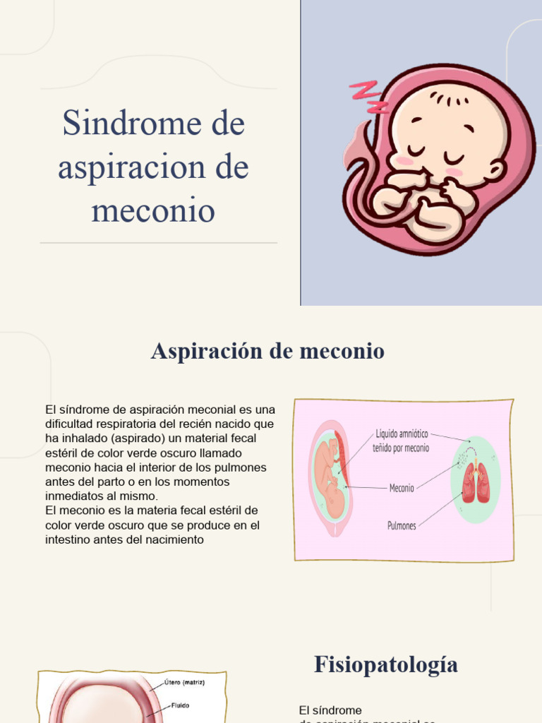 Síndrome de Aspiración de Meconio | PDF | Neumonía | Especialidades Medicas