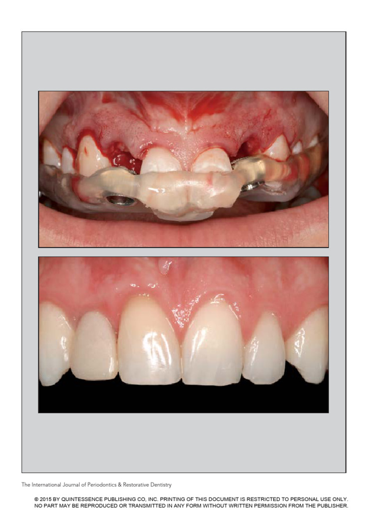 The International Journal of Periodontics & Restorative Dentistry | PDF ...
