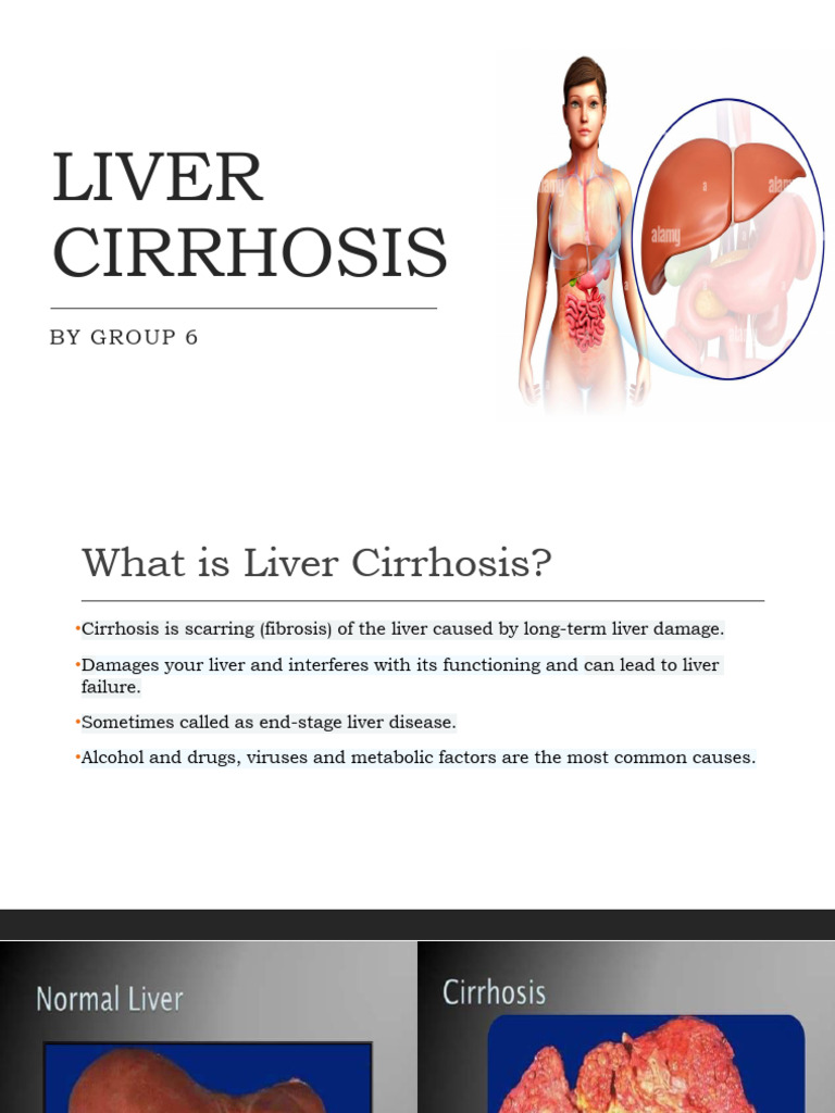 Liver Cirrhosis | PDF | Cirrhosis | Liver