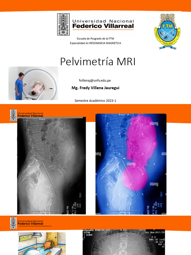Pelvimetria RM | PDF | Pelvis | Parto