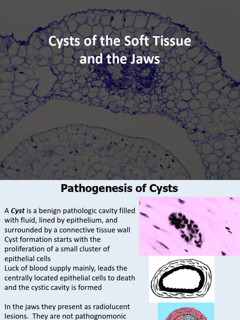 3 CYSTS of The Soft Tissues and The Jaws PDF | PDF | Medical ...