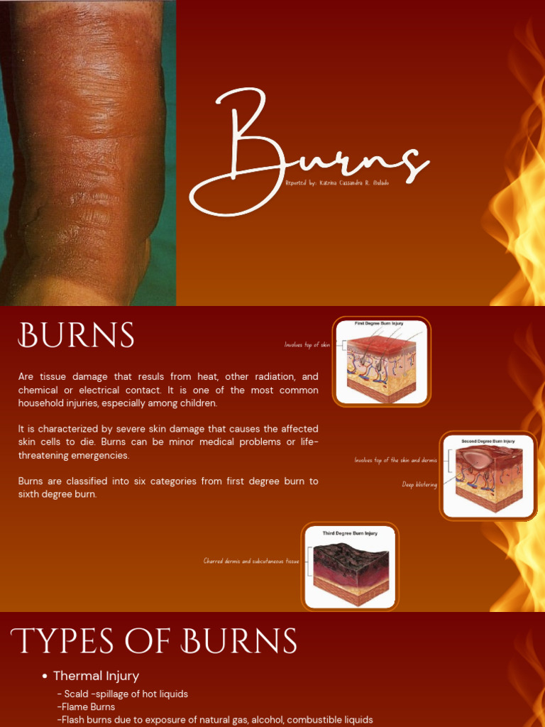 BURNS | PDF | Burn | Hand