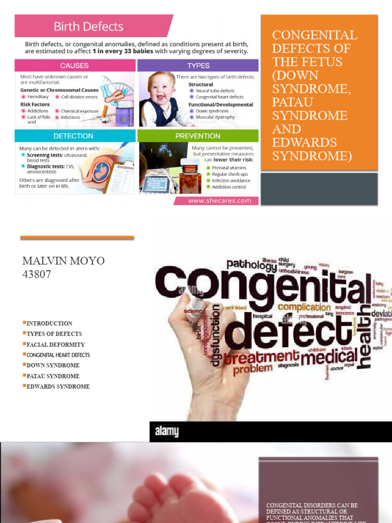 Congenital Defects of The Fetus (Down Syndrome | PDF | Down Syndrome | Congenital Heart Defect
