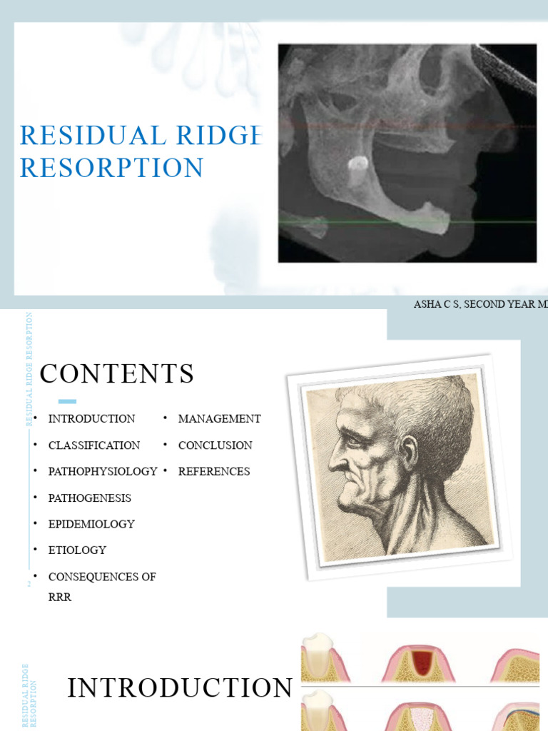 Residual Ridge Resorption: Asha C S, Second Year Mds | PDF | Bone ...