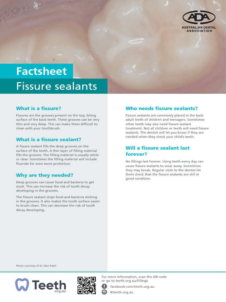 Fissure Sealants: Protecting Teeth Grooves | PDF | Human Tooth ...