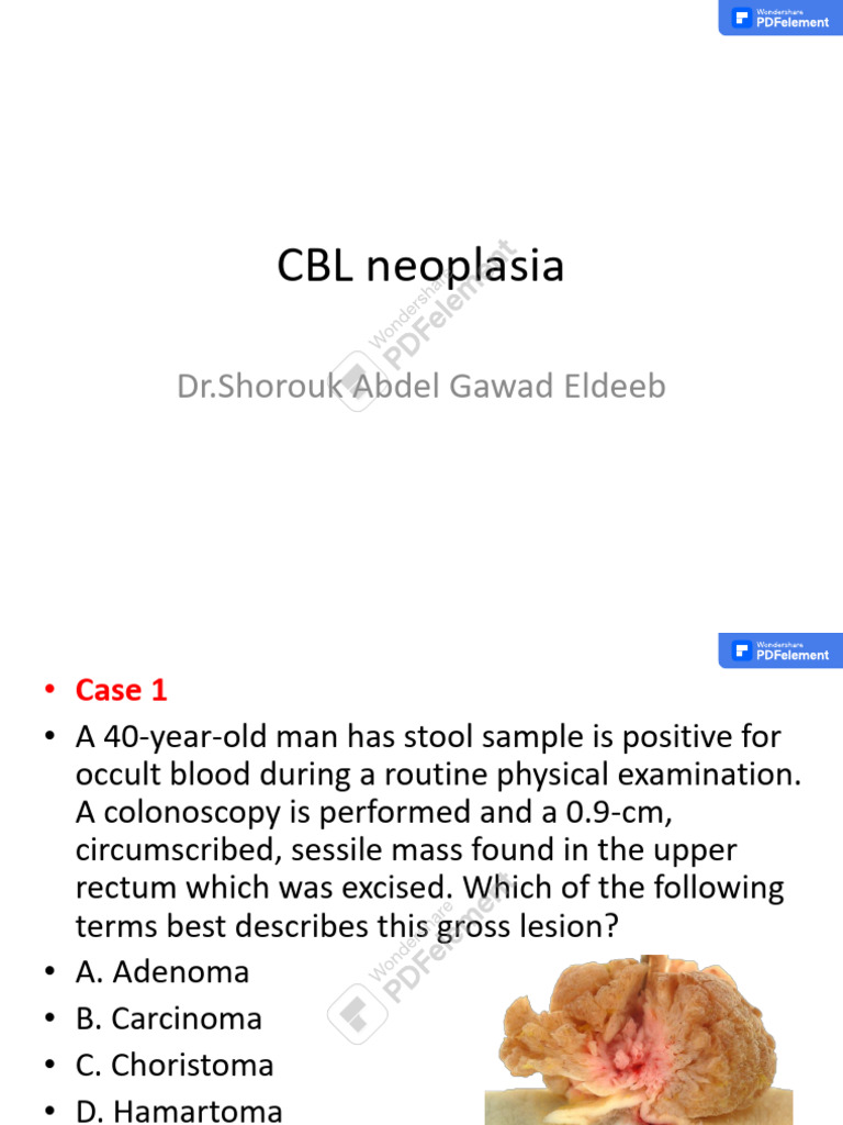 CBL Neoplasia | PDF | Adenoma | Metastasis