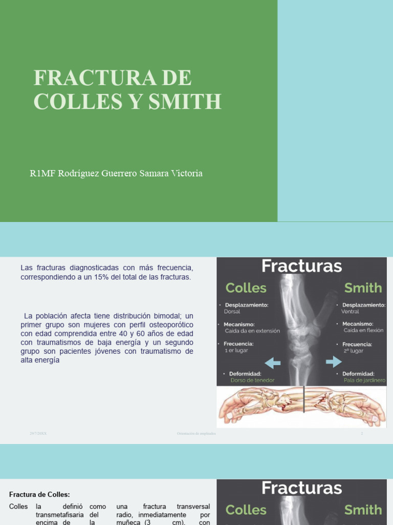Fractura de Colles y Smith | Descargar gratis PDF | Enfermedades y trastornos | Medicina CLINICA