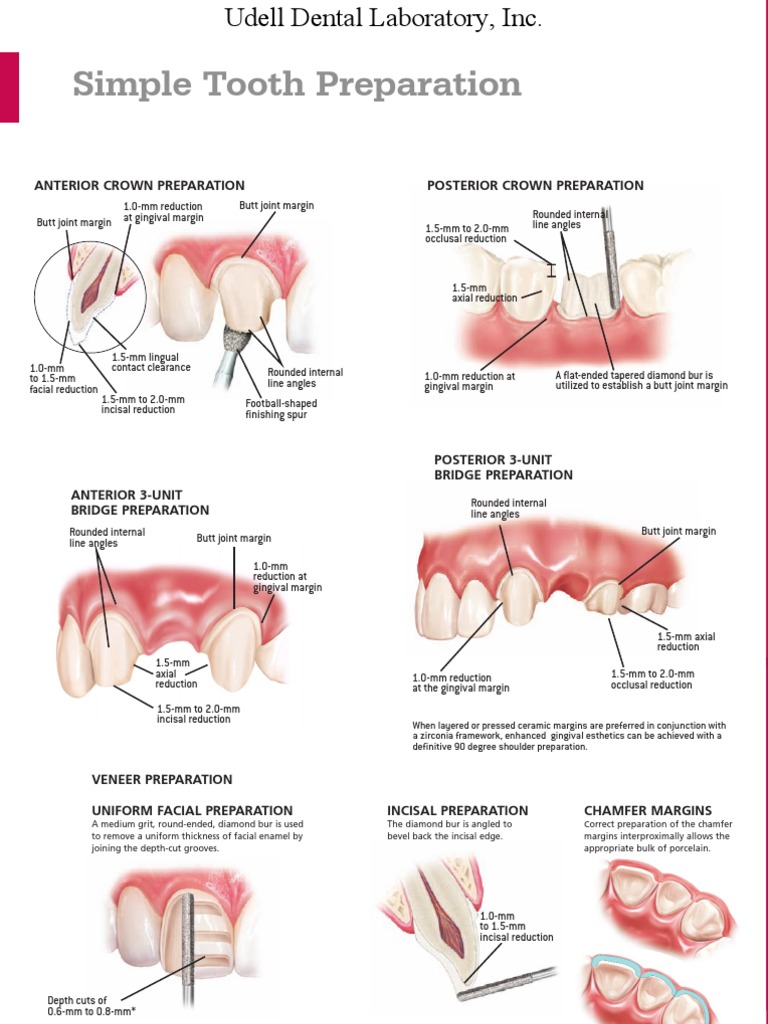 e.max Prep Guide | Dentistry Branches | Dentistry