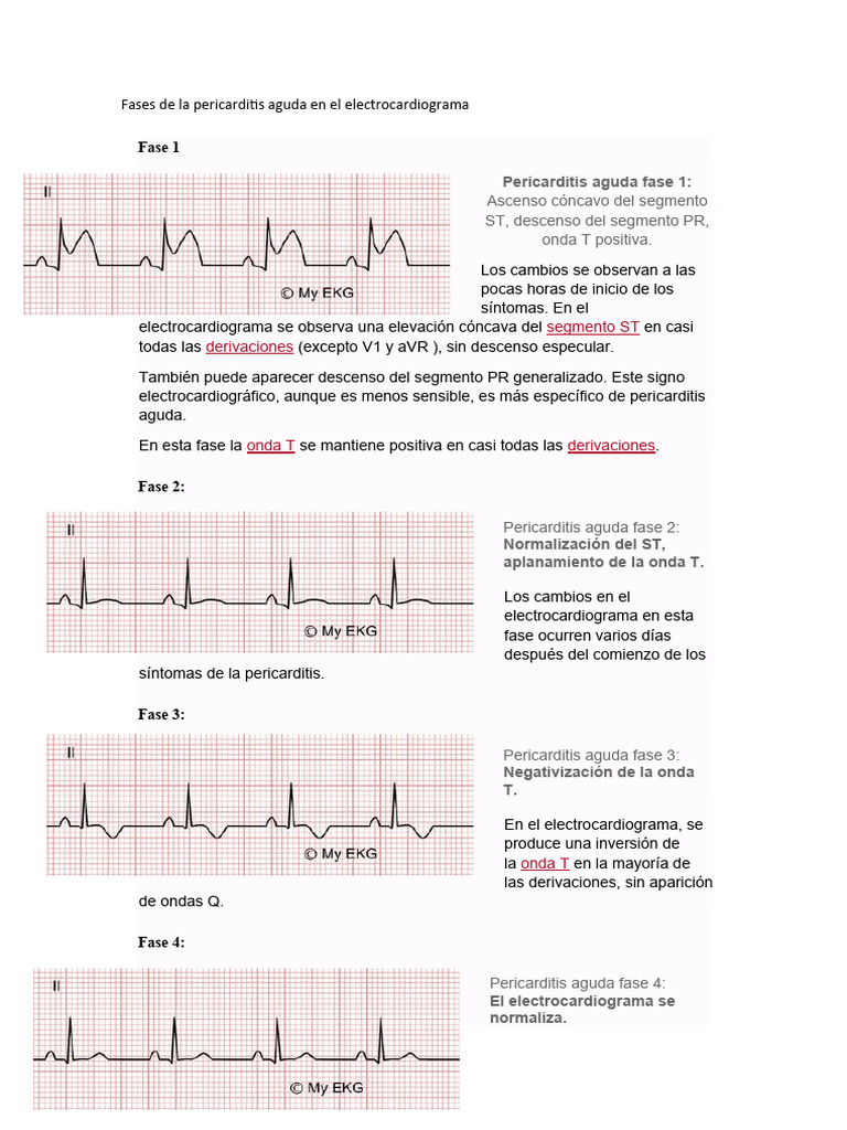 Fases del ECG en pericarditis aguda | PDF | Electrocardiografia ...