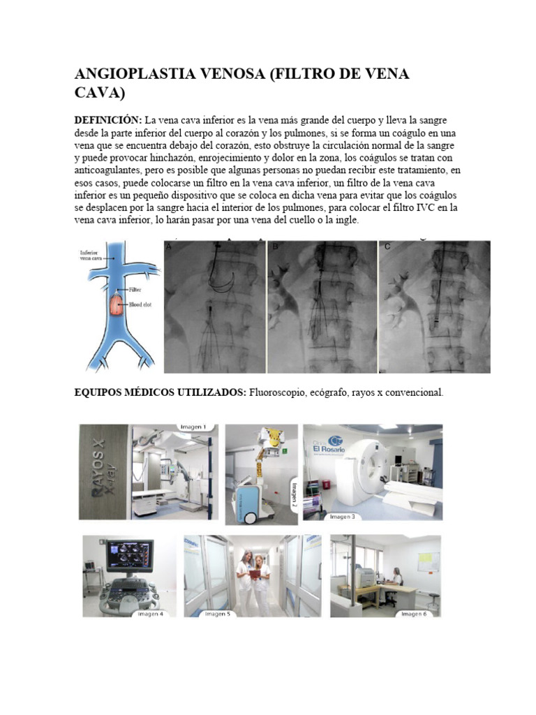 (Angioplastia Venosa (Filtro de Vena Cava) | PDF | Cirugía | Radiología