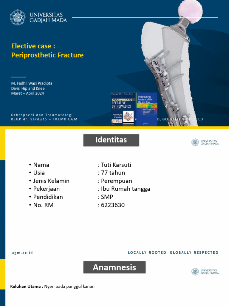 Priprosthetic Fracture | PDF | Implant (Medicine) | Medicine