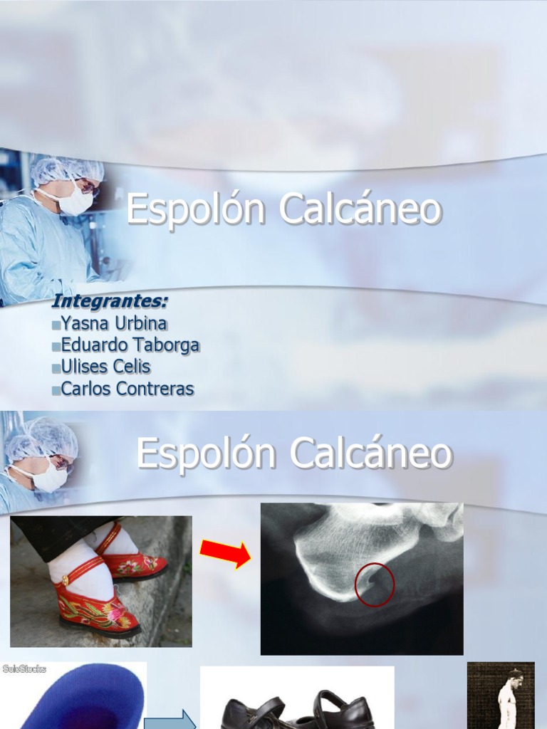 Espolón Calcáneo | PDF | Dolor | Pie