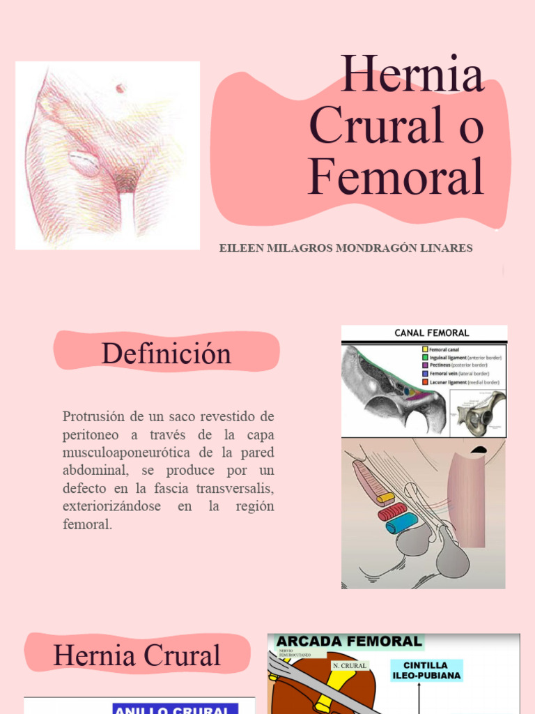 Hernia Crural | PDF | Examen físico | Especialidades Medicas