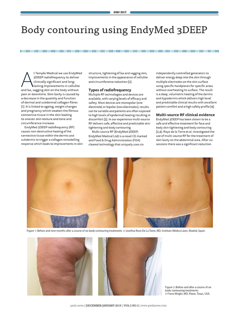 2015 01 PMFA Body Contouring Using EndyMed 3DEEP | PDF | Skin | Bariatric Surgery