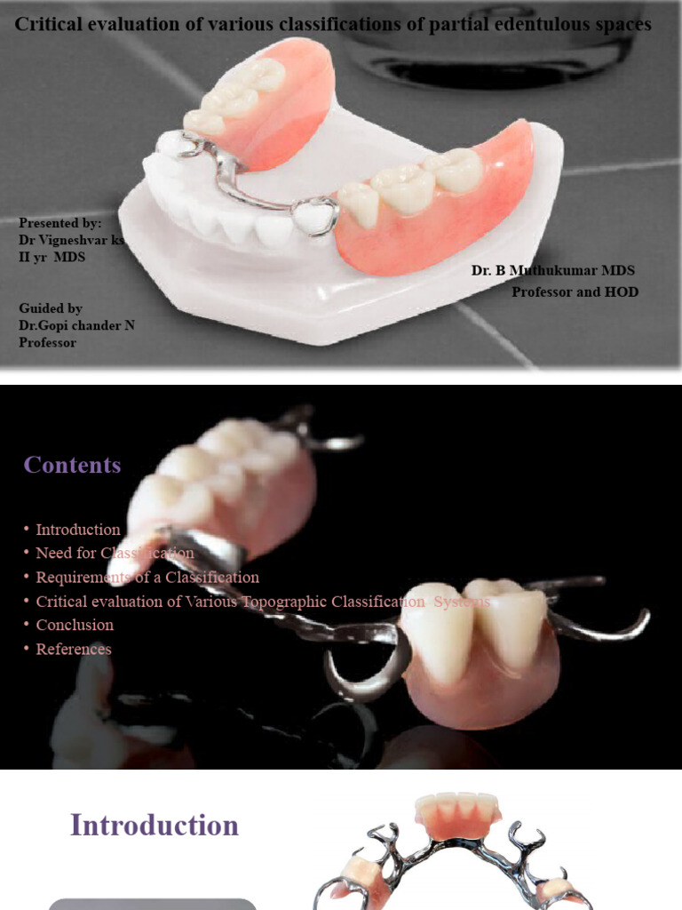 critical analysis of rpd classification system | PDF | Dentistry | Dental Anatomy