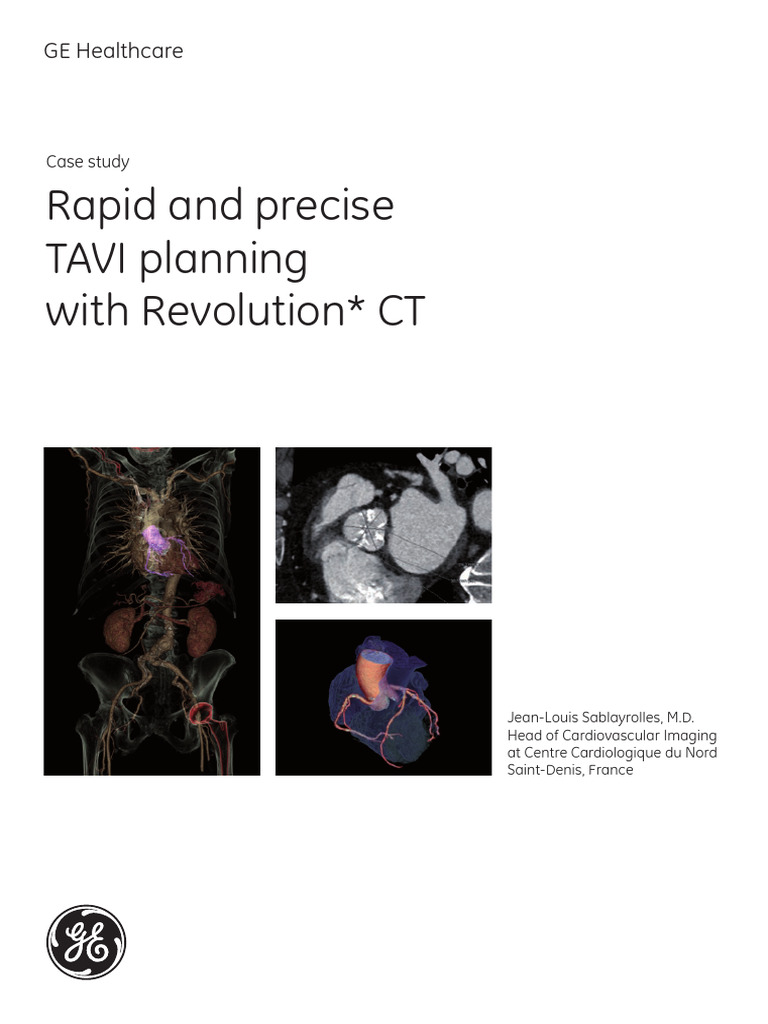 CT - Revolution CT Case Study - TAVI Planning | PDF | Ct Scan | Heart