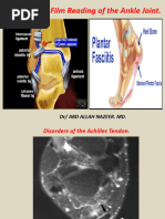 Interdigital (Morton's) Neuroma - Foot & Ankle - Orthobullets | PDF ...