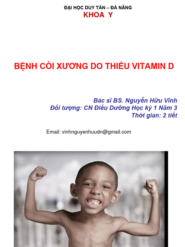 11. Bệnh còi xương do thiếu VTM D | PDF