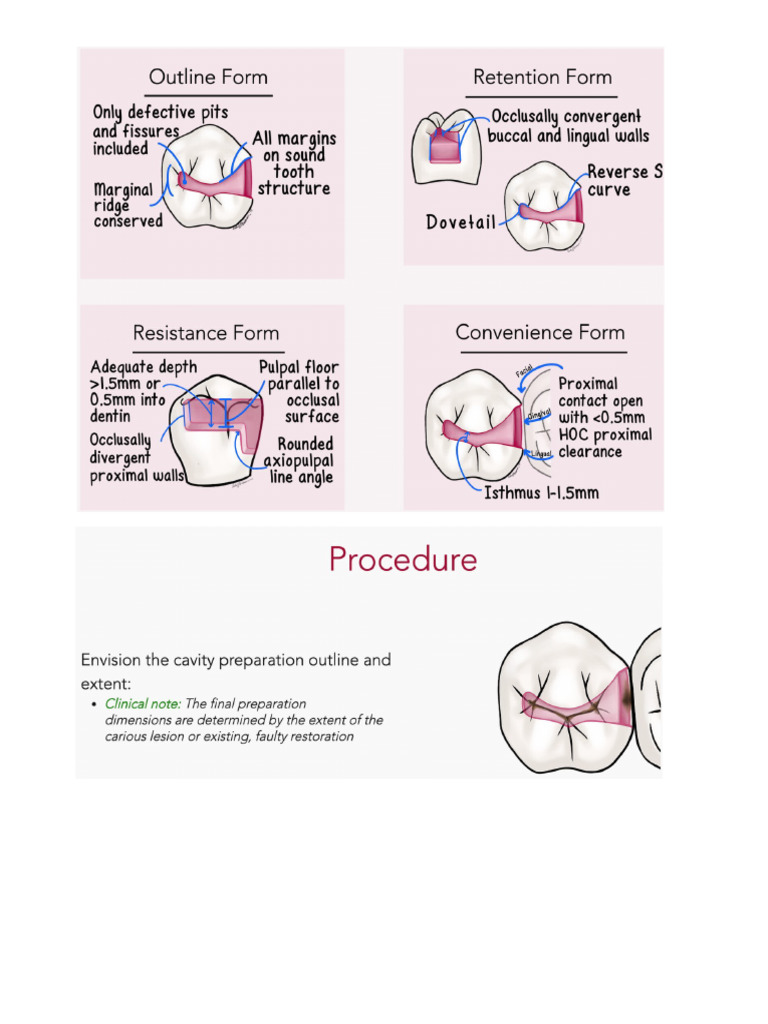 Class II Cavity Preparation Dentistry | PDF