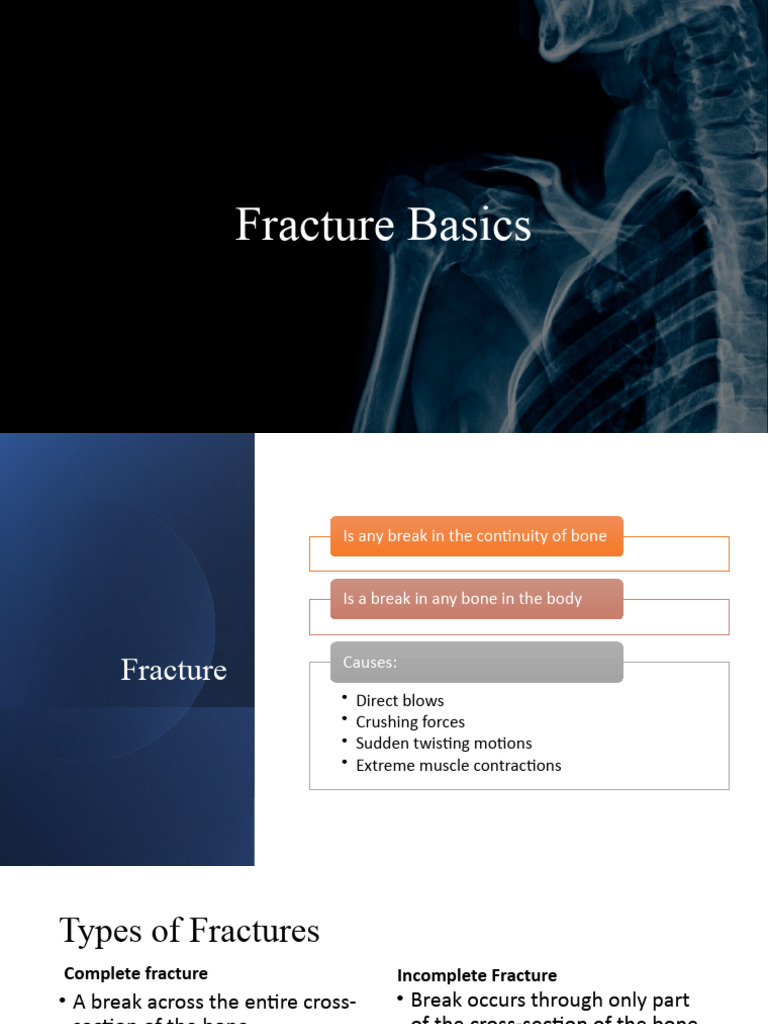 Fracture Basics | PDF | Bone | Injury