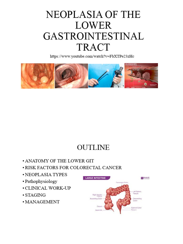 Lower GI Neoplasia Overview | PDF | Colorectal Cancer | Cancer