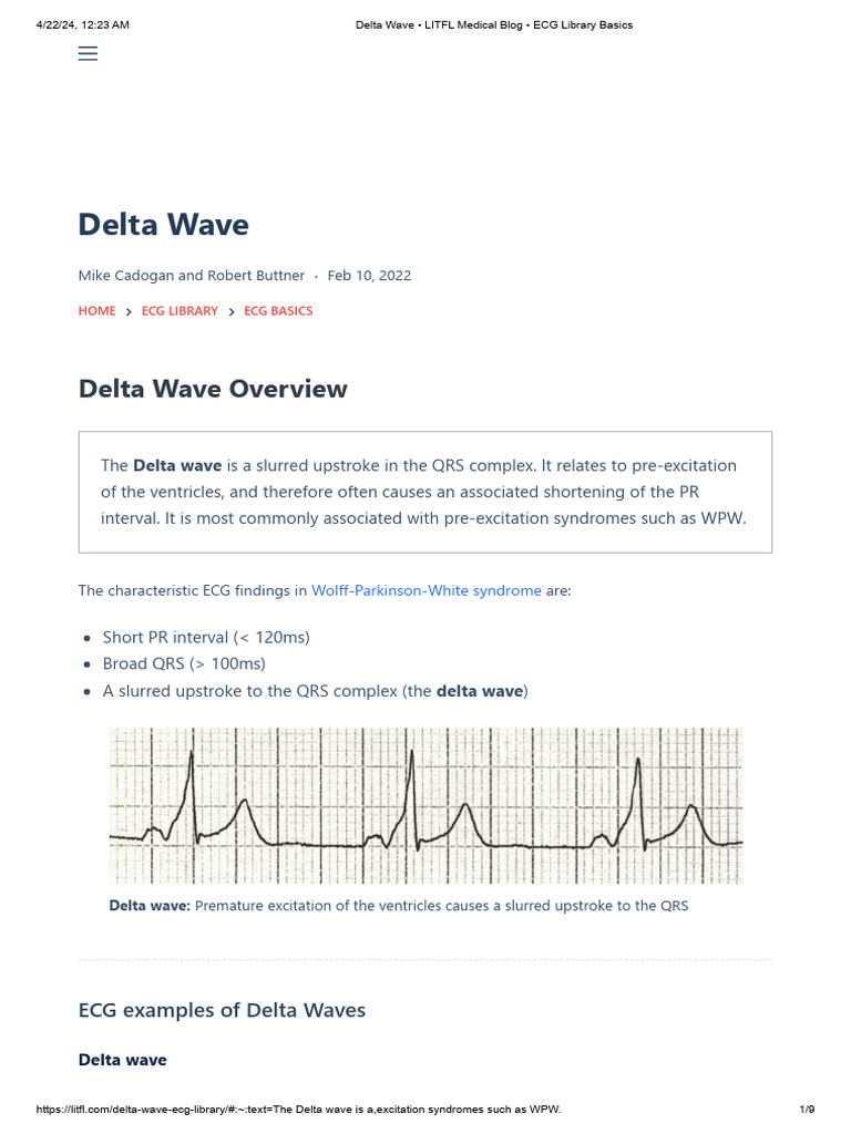 Delta Wave - LITFL Medical Blog - ECG Library Basics | PDF | Cardiac ...