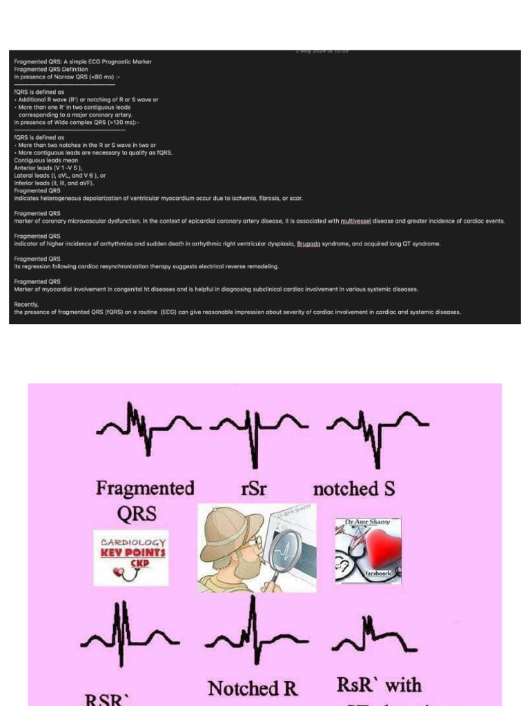 Fragmented QRS | PDF