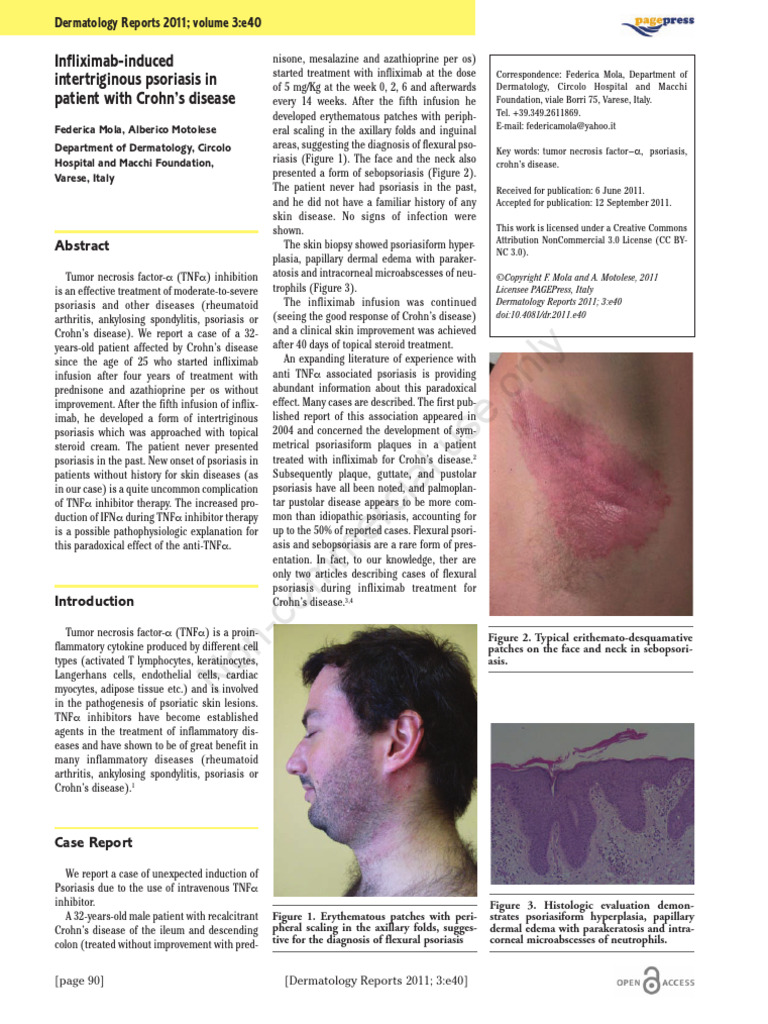Infliximab-Induced Intertriginous Psoriasis in Patient With Crohn's ...