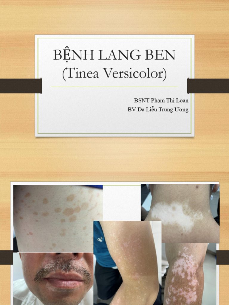 Bệnh Lang Ben 1 | PDF