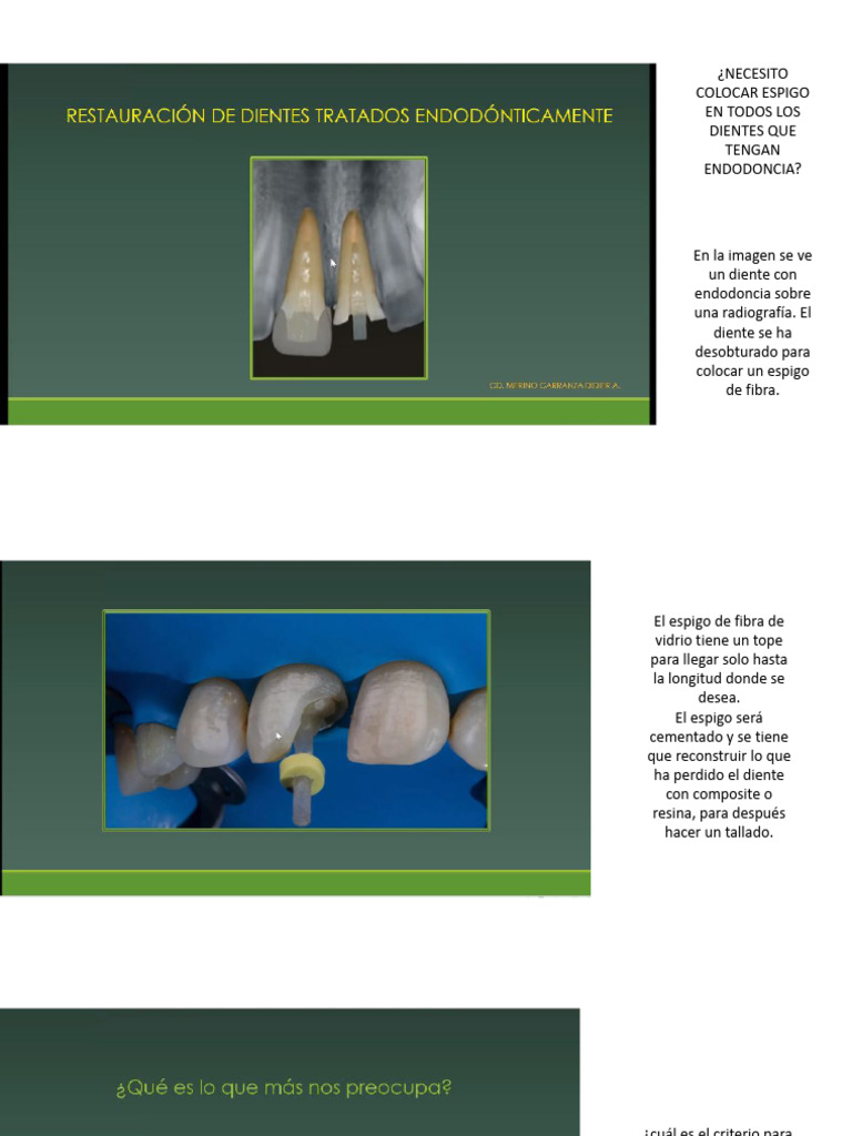 Espigos en Dientes con Endodoncia | PDF | Especialidades Medicas ...