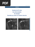Revisión del intervalo rotador en MRI | PDF | Hombro | Extremidades ...