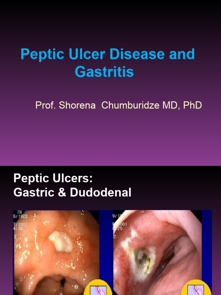 Peptic Ulcer Disease and Gastritis | PDF | Causes Of Death | Clinical ...