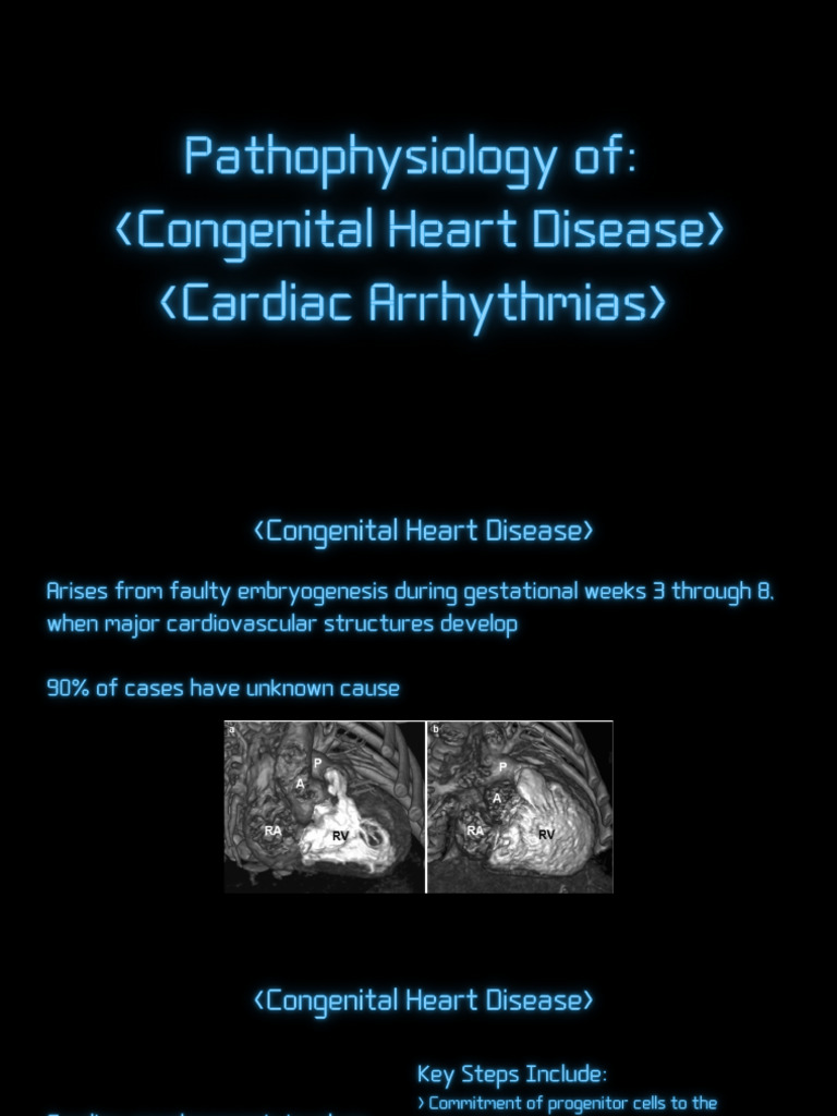 Pathophysiology of Congenital Heart Disease Cardiac Arrhythmias | PDF