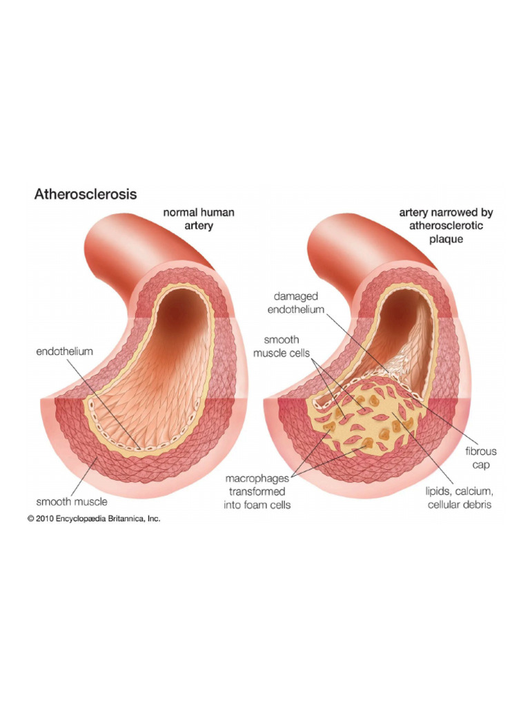 Atherosclerosis | PDF