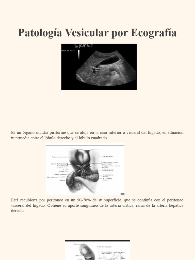 Ecografía en Patología Vesicular | PDF | Vesícula biliar ...
