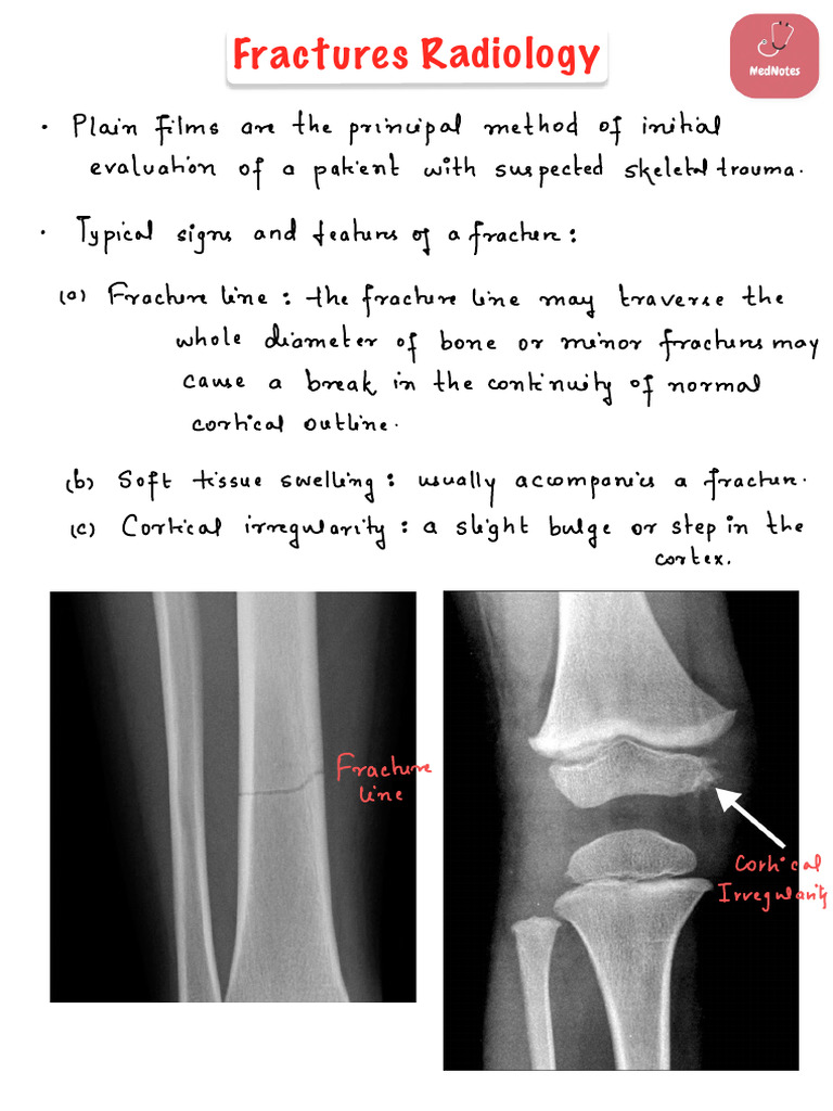 Fractures Radiology | Download Free PDF | Bone | Clinical Medicine