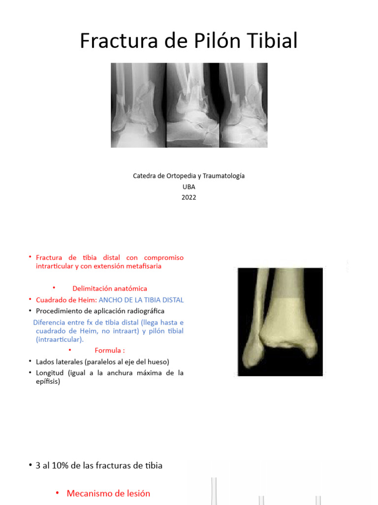 FX Pilon Tibial | PDF | Hueso | Tobillo