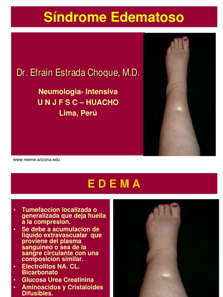 Sindrome Edematoso | PDF | Edema | Especialidades Medicas