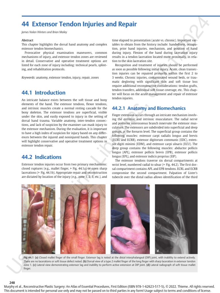 Extensor Tendon Injuries & Repair (Mallet Finger) Reconstrucitve | PDF ...