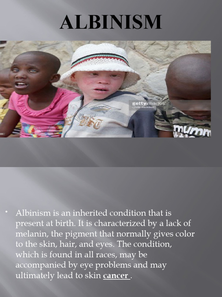 Albinism | PDF