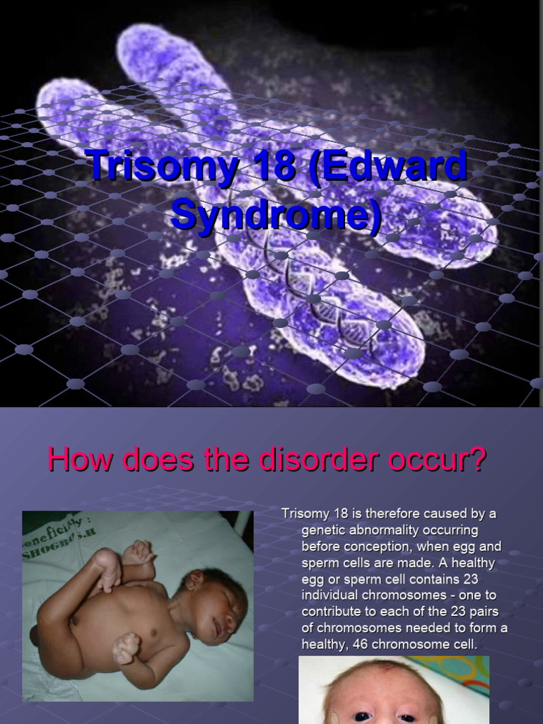 Edward's Syndrome (Trisomy18) | PDF | Causes Of Death | Clinical Medicine