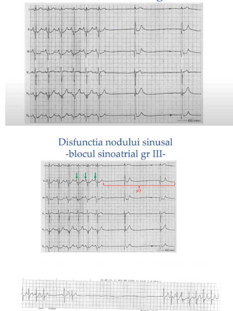 Exemple Ekg | PDF