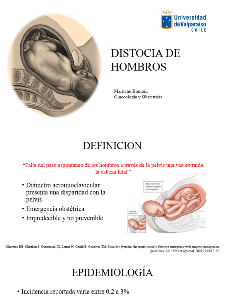 Distocia de Hombros | PDF | Parto | Especialidades Medicas