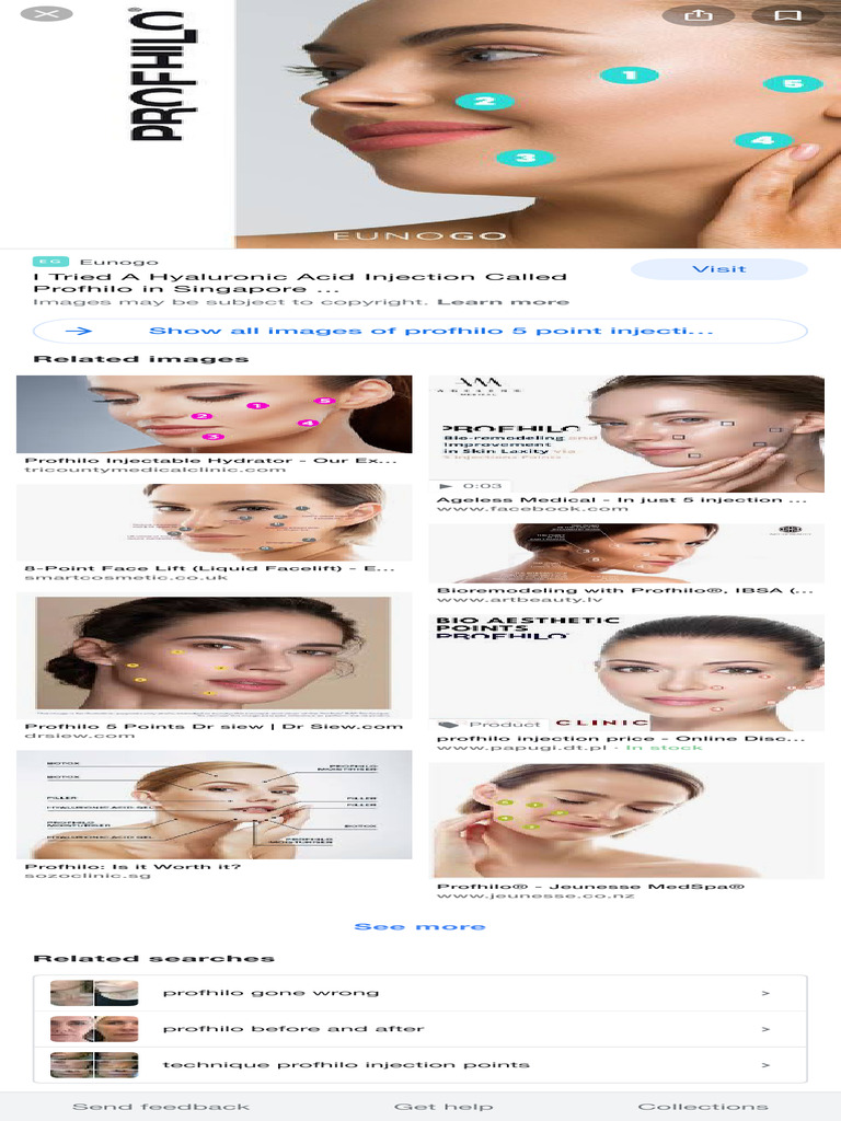 Profhilo 5 Point Injection - Google Search | PDF | Clinical Medicine ...