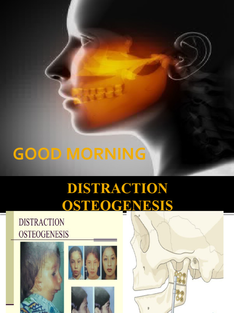 Distraction Osteogenesis | PDF | Bone | Surgery