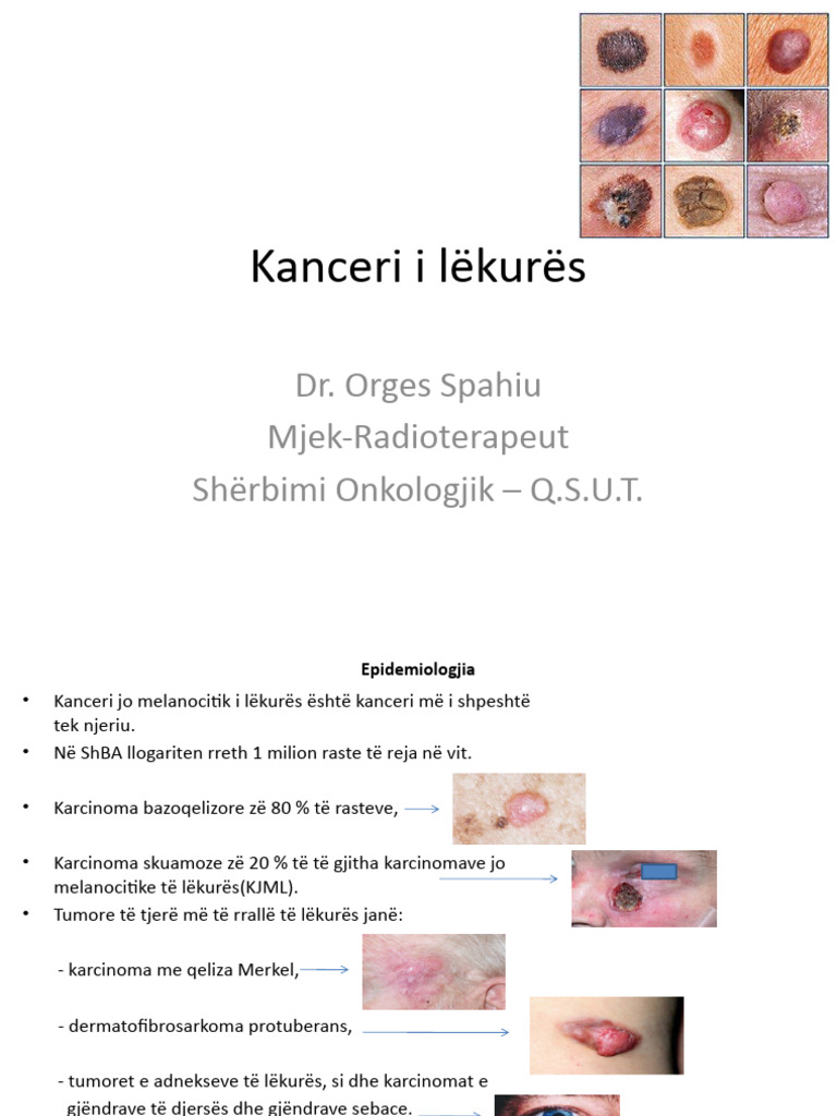Kanceri i lëkurës projekt | PDF