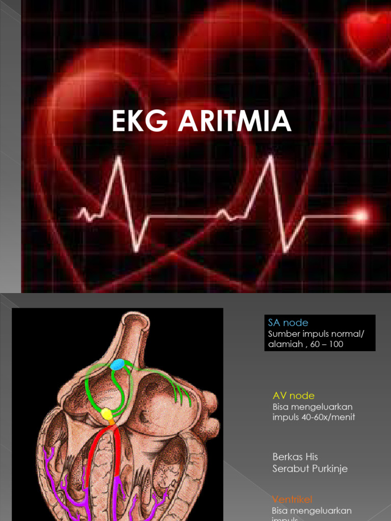 ECG ARITMIA (Repaired) | PDF | Electrocardiography | Cardiovascular Physiology
