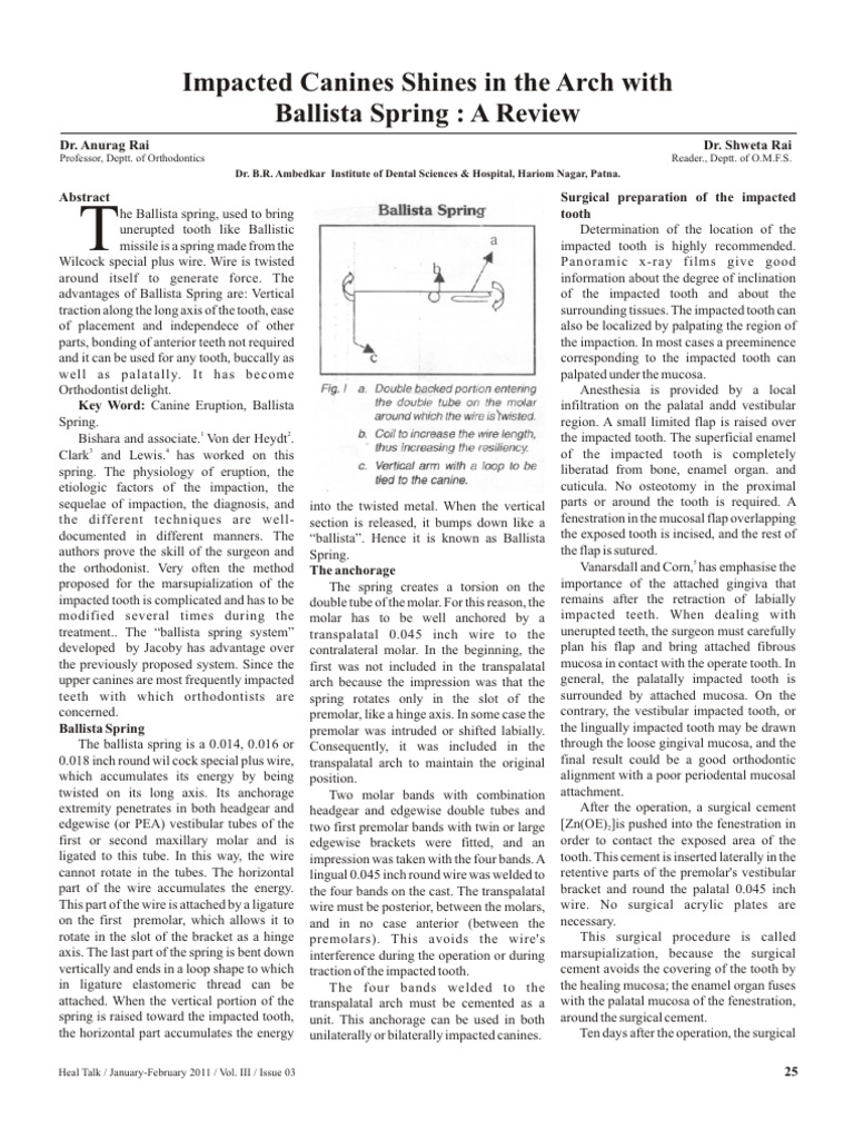 Impacted Canines Shines in The Arch With Ballista Spring: A Review ...